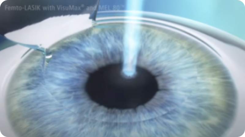 【2024年最新】近視雷射懶人包｜一篇看懂近視雷射｜SMILE、LASIK、PRK 差在哪？近視雷射安全嗎？近視雷射的恢復期、副作用與手術費用 - 遠見眼科 - 台北101旗艦中心