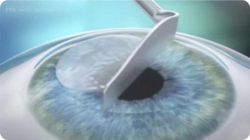 【2024年最新】近視雷射懶人包｜一篇看懂近視雷射｜SMILE、LASIK、PRK 差在哪？近視雷射安全嗎？近視雷射的恢復期、副作用與手術費用 - 遠見眼科 - 台北101旗艦中心